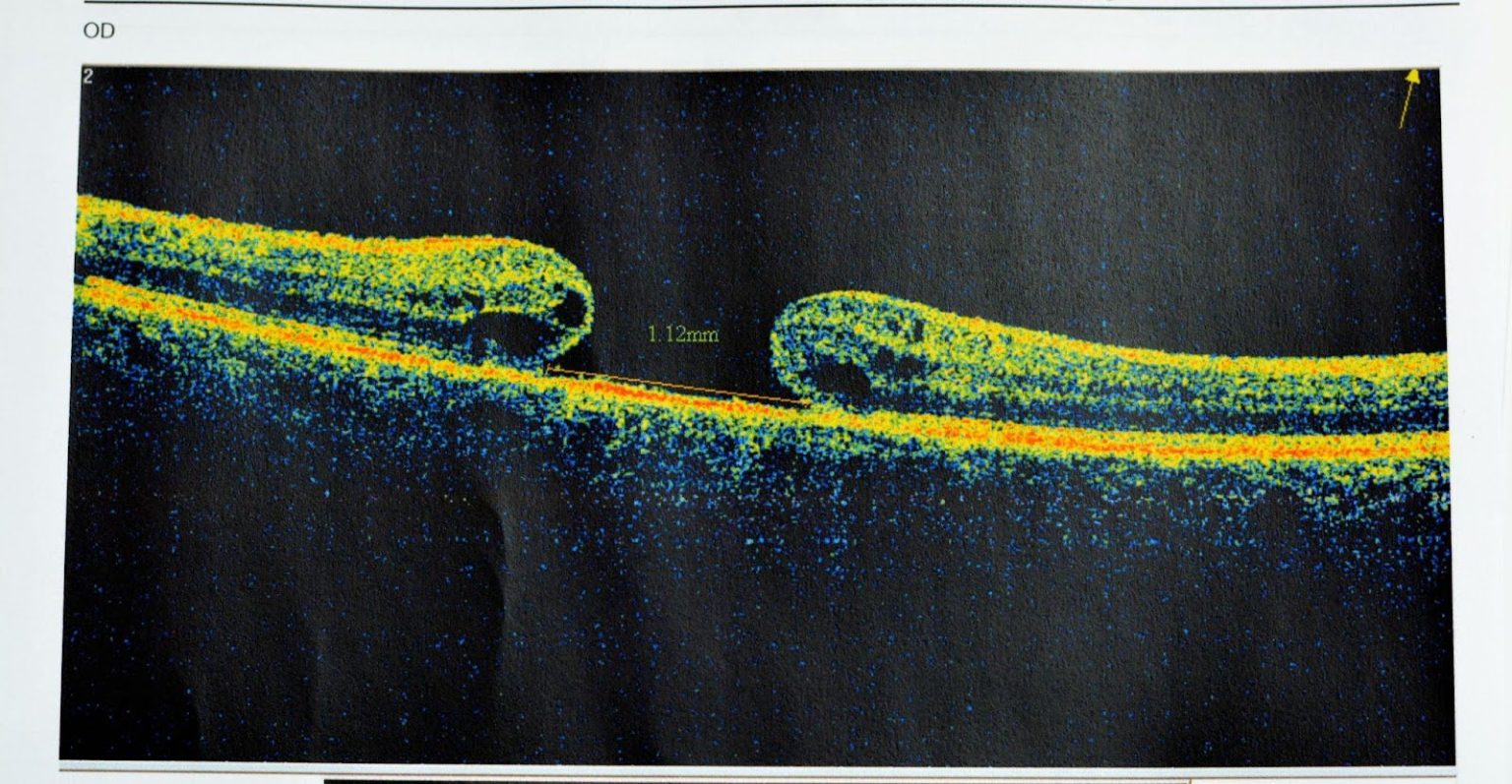 Macular hole - Southside Eye Centre